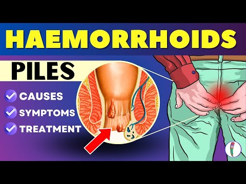 Hemorrhoids (Piles) Symptoms, Causes, Treatment | Piles problem ...